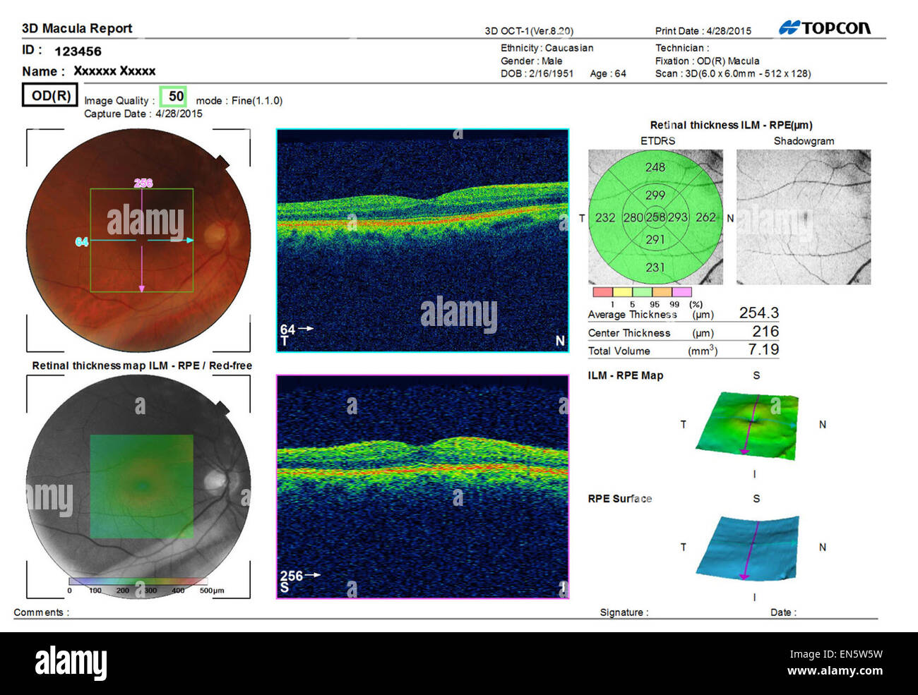 Eye scan ultra sound test showing 3D MACULA REPORT of human eye vist ...