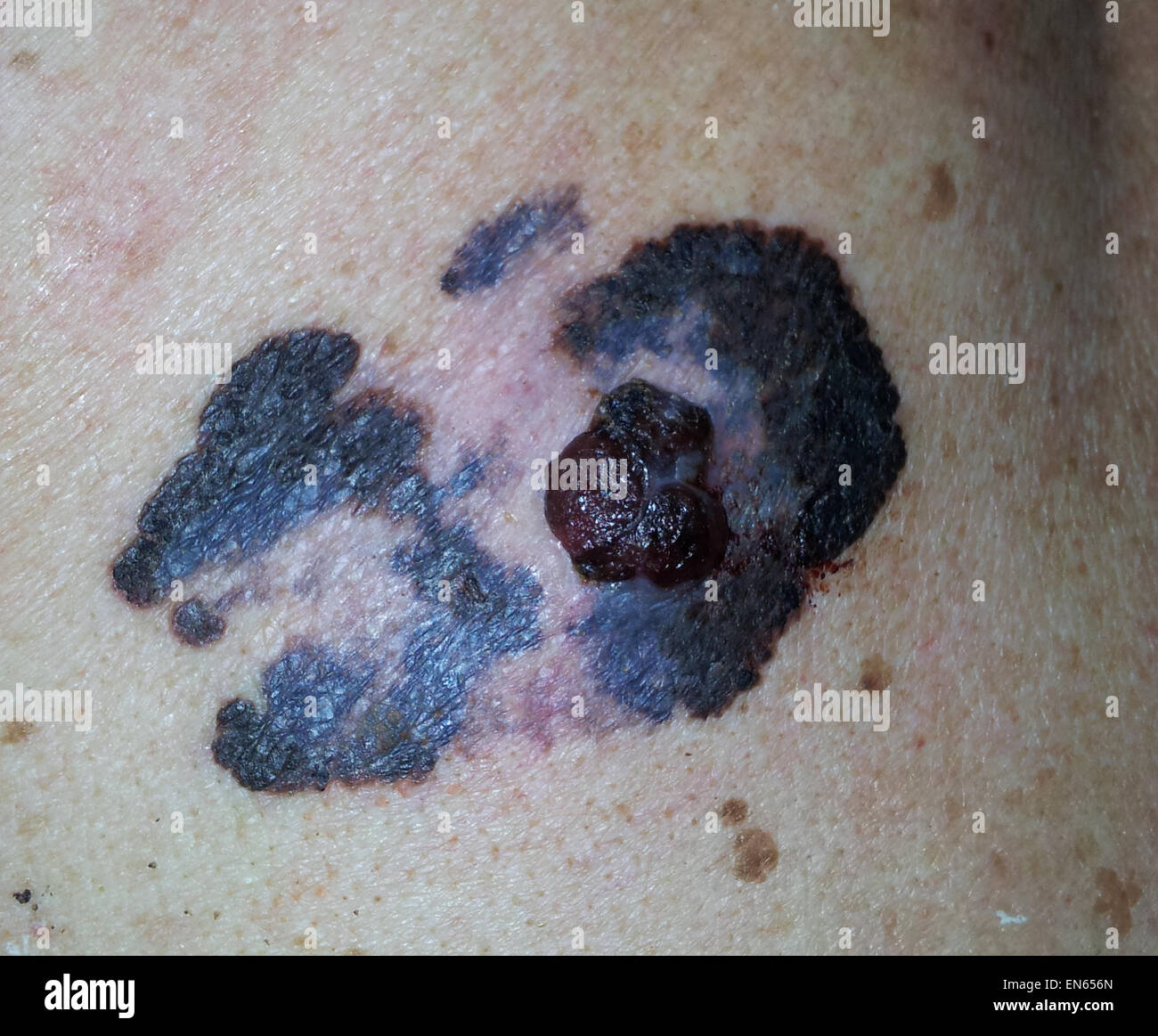 Malignan melanoma, cancer of skin Stock Photo - Alamy