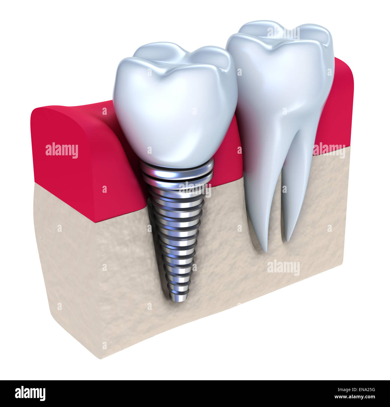 Dental implant - implanted in jaw bone. Isolated on white Stock Photo ...