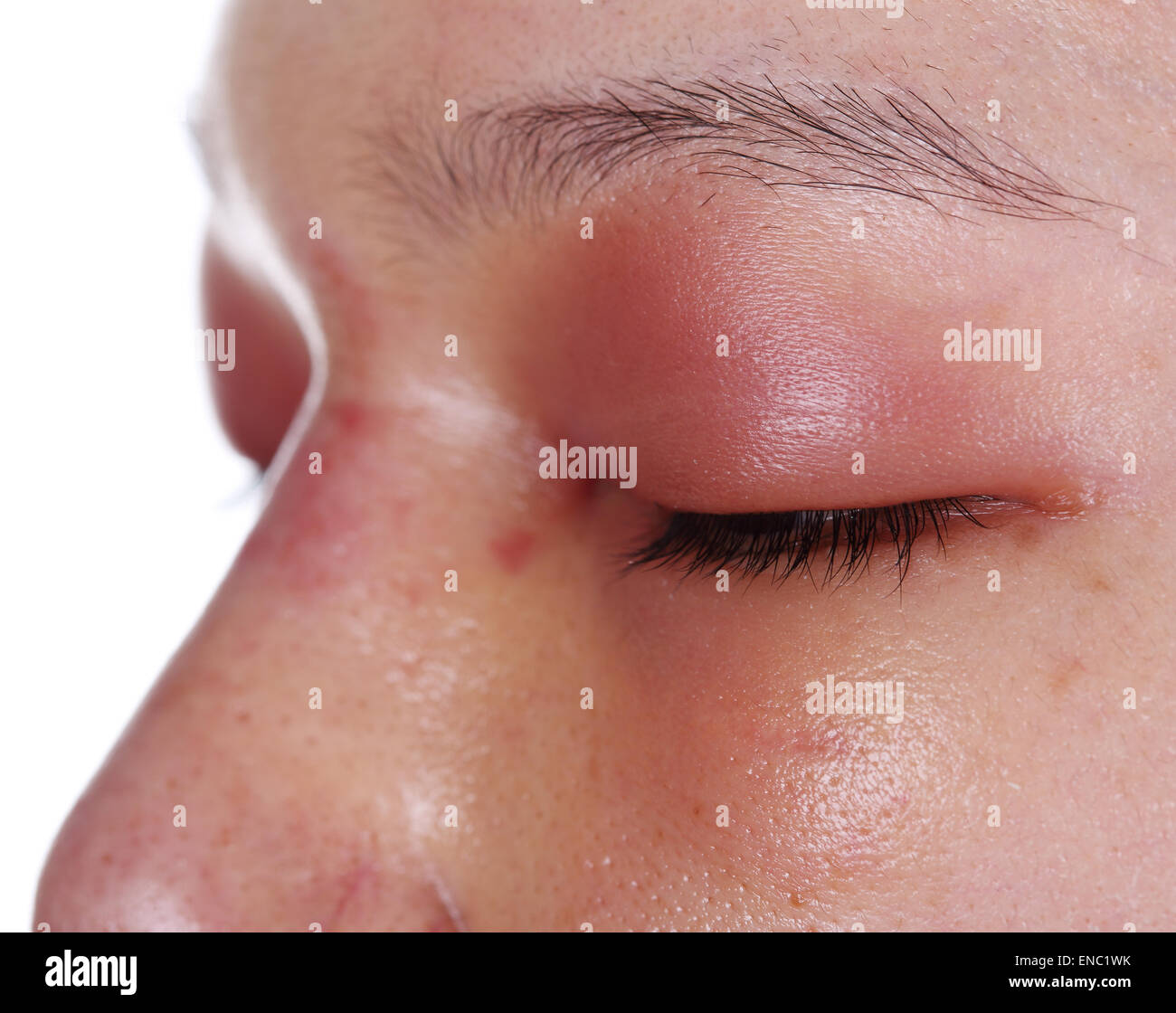 close-up of upper eye lid swell after nose job plastic surgery Stock ...