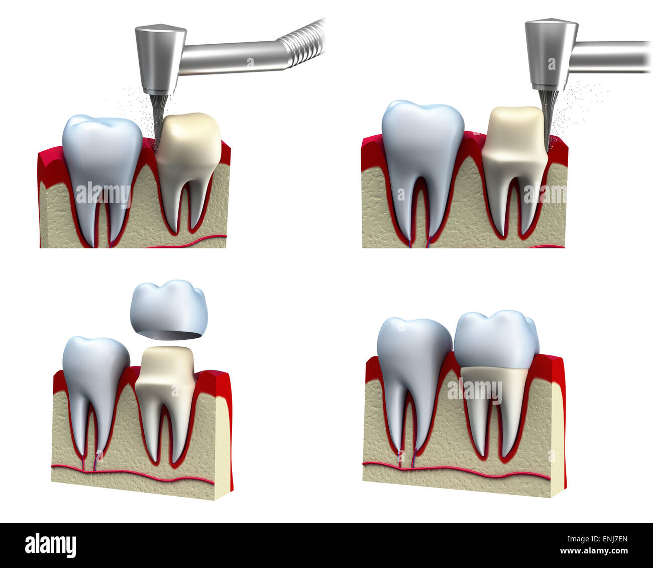 Dental crown installation process, isolated on white Stock Photo - Alamy