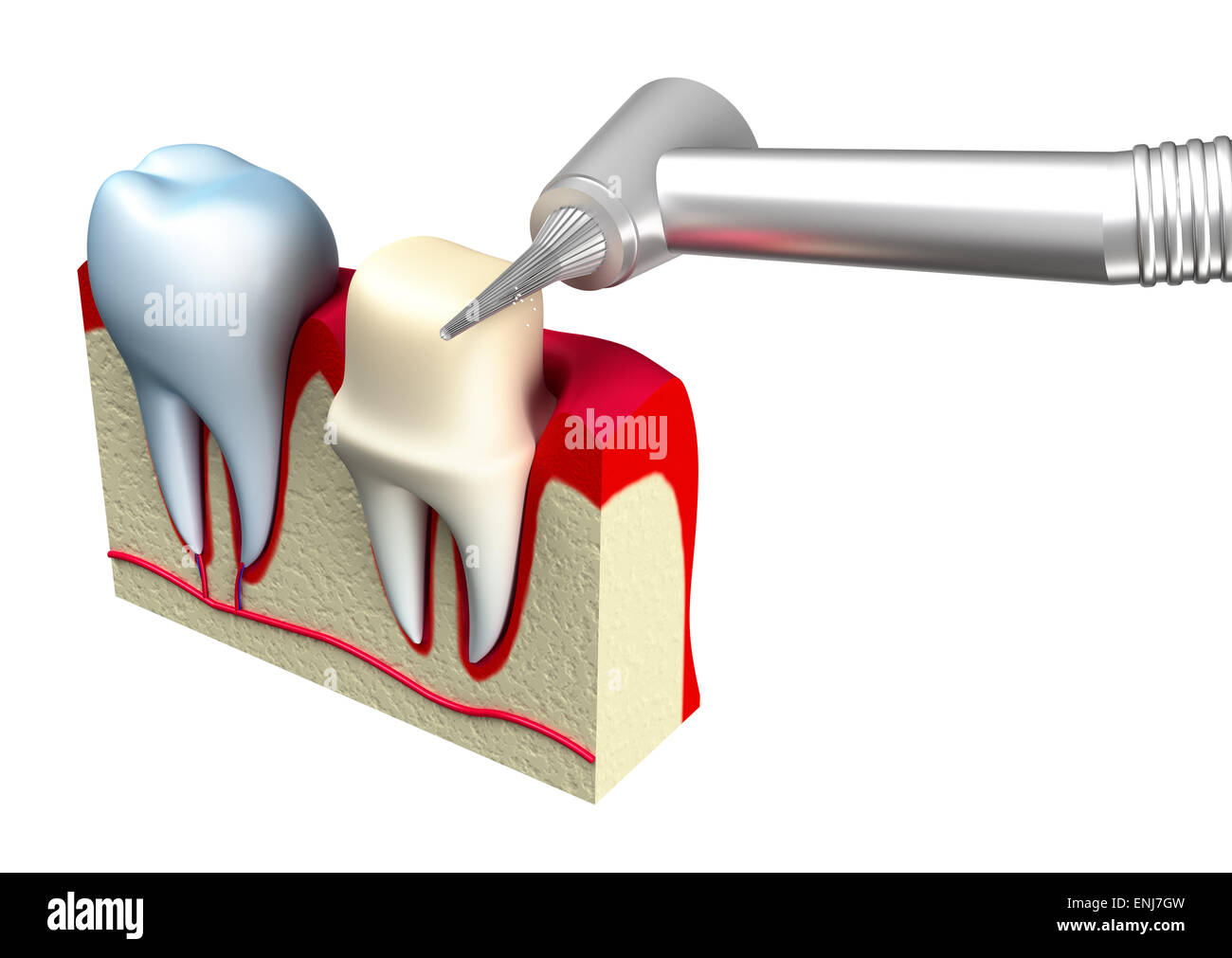 Preparation of the tooth crown for prosthetics Stock Photo - Alamy