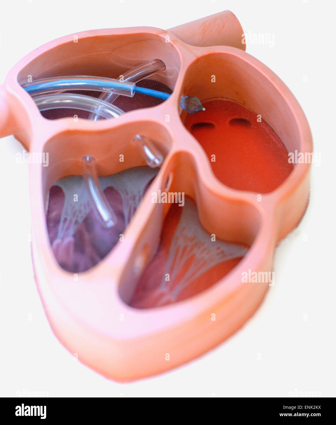 Atrial septal defect hi-res stock photography and images - Alamy
