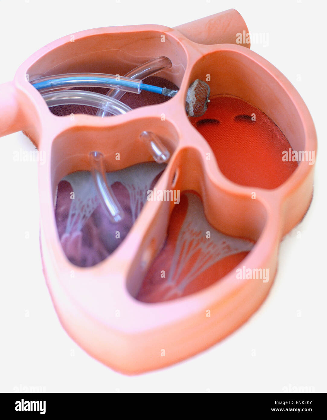 Atrial septal defect hi-res stock photography and images - Alamy