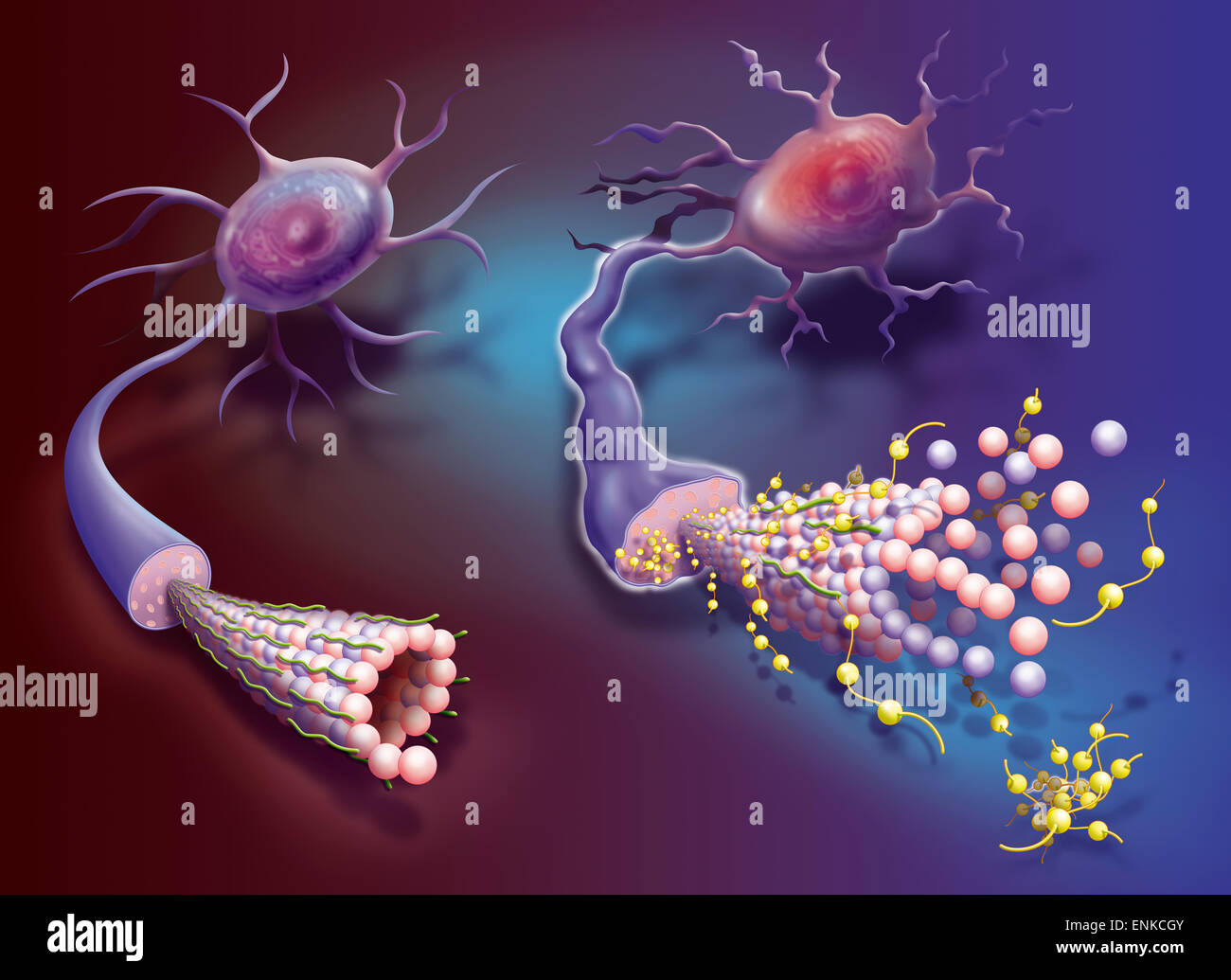 Neurofibrillary tangle hi-res stock photography and images - Alamy
