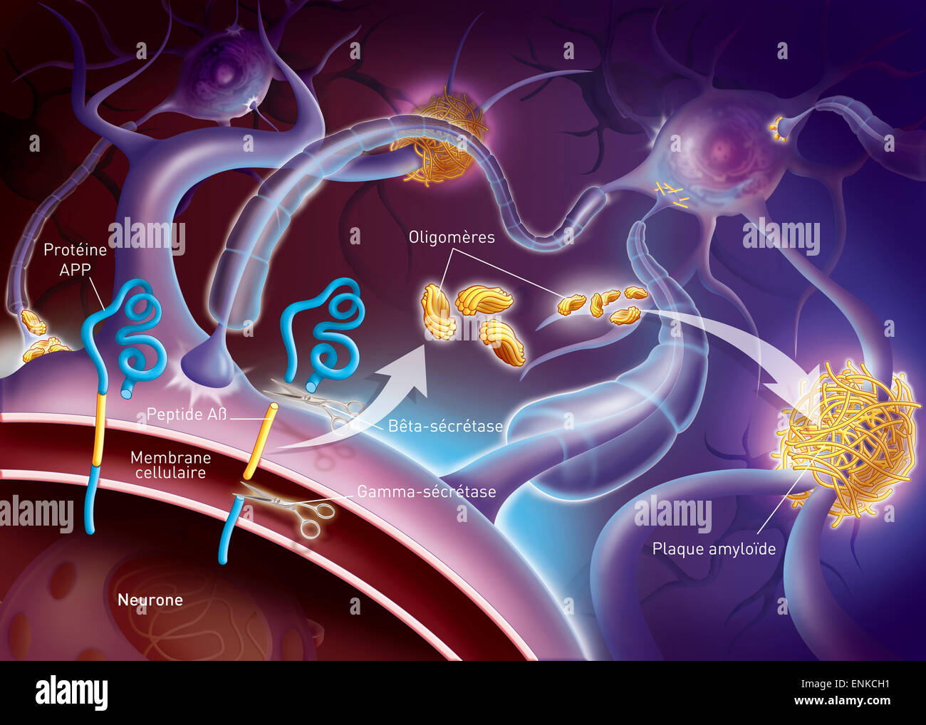 Alzheimer's disease, drawing Stock Photo - Alamy