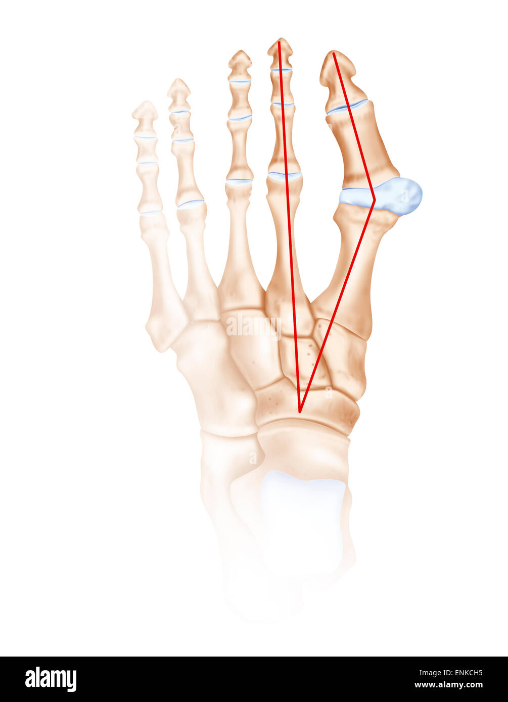 Hallux valgus illustration bunion hi-res stock photography and images ...