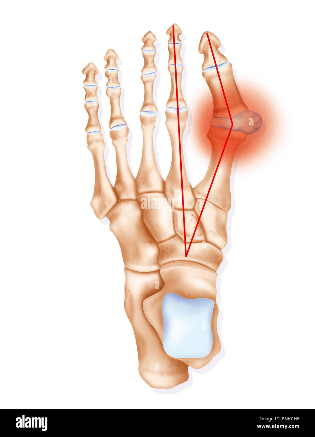 Hallux valgus hi-res stock photography and images - Alamy