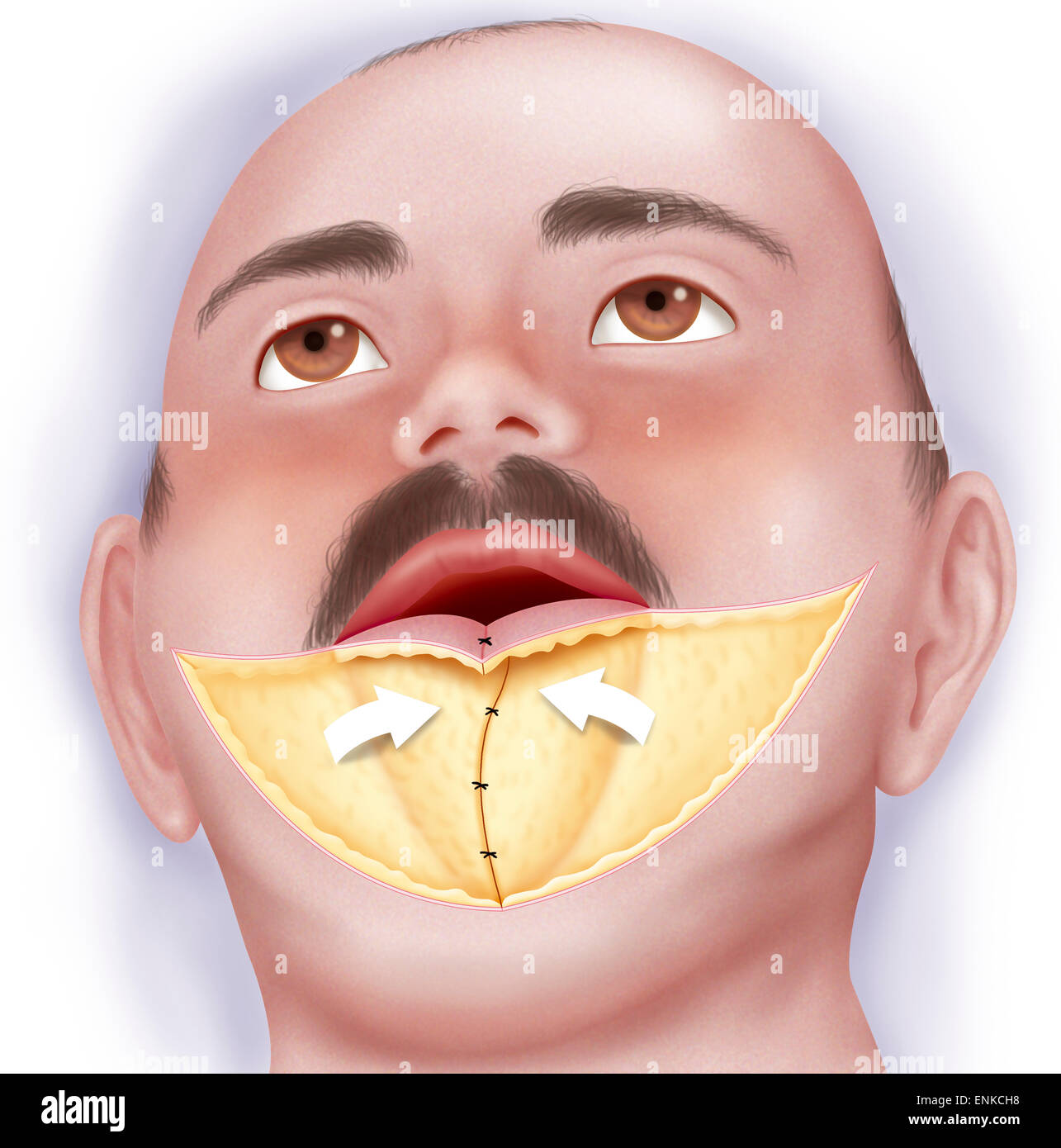 Facial reconstruction hi-res stock photography and images - Alamy