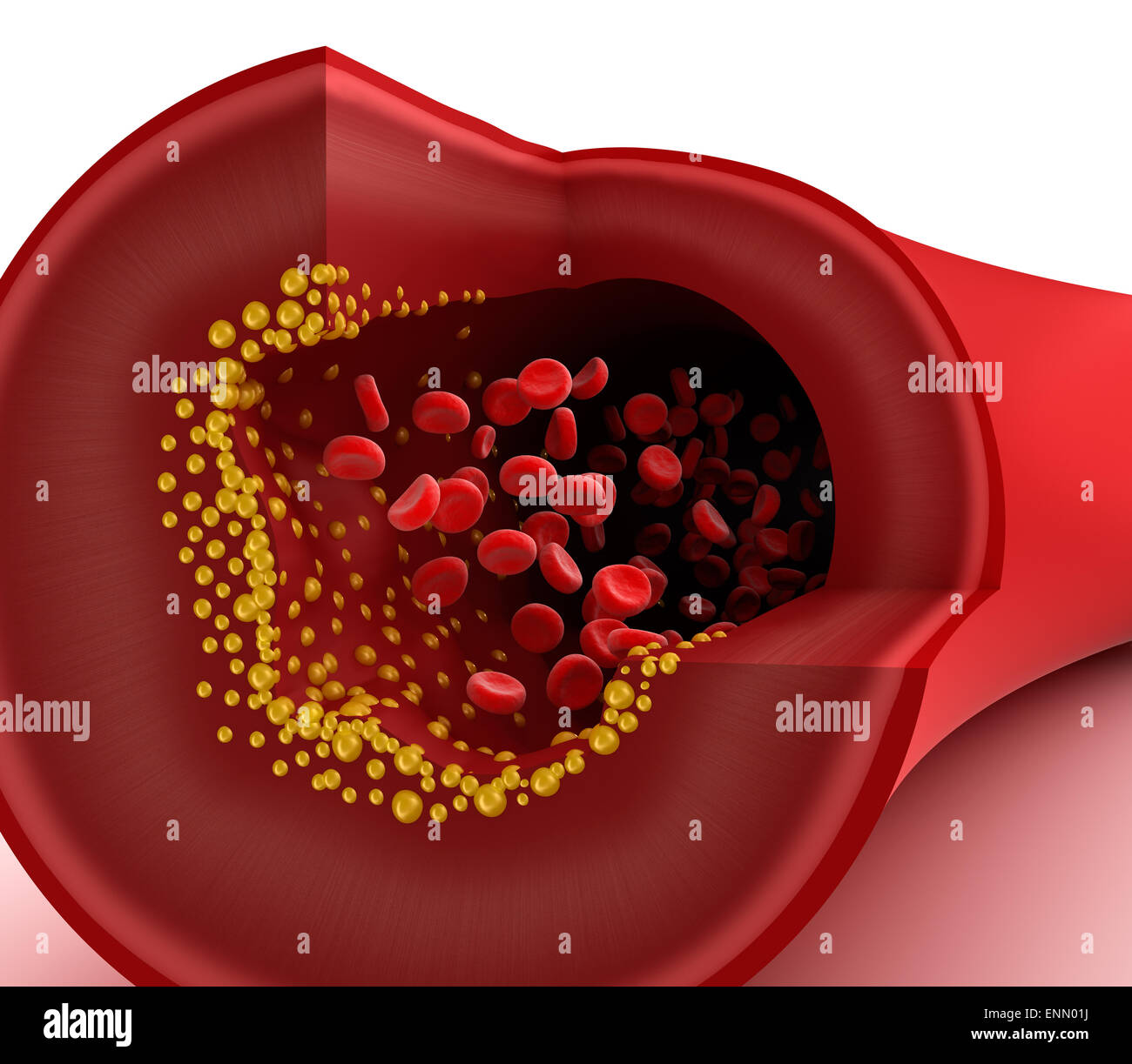 cholesterol plaque in blood vessel Stock Photo - Alamy