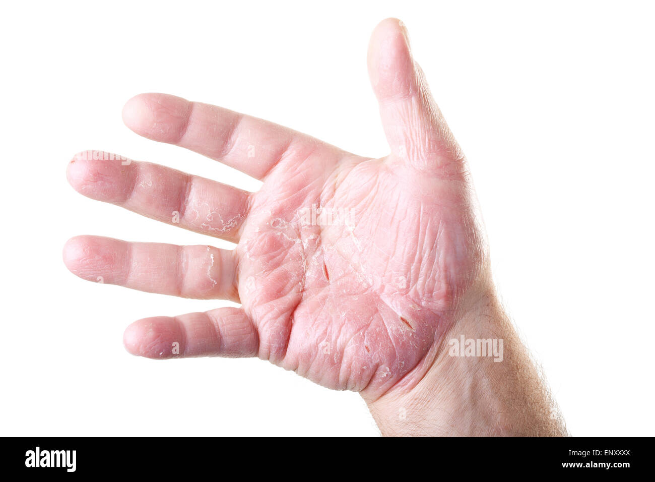male palm with eczema isolated on white background Stock Photo - Alamy