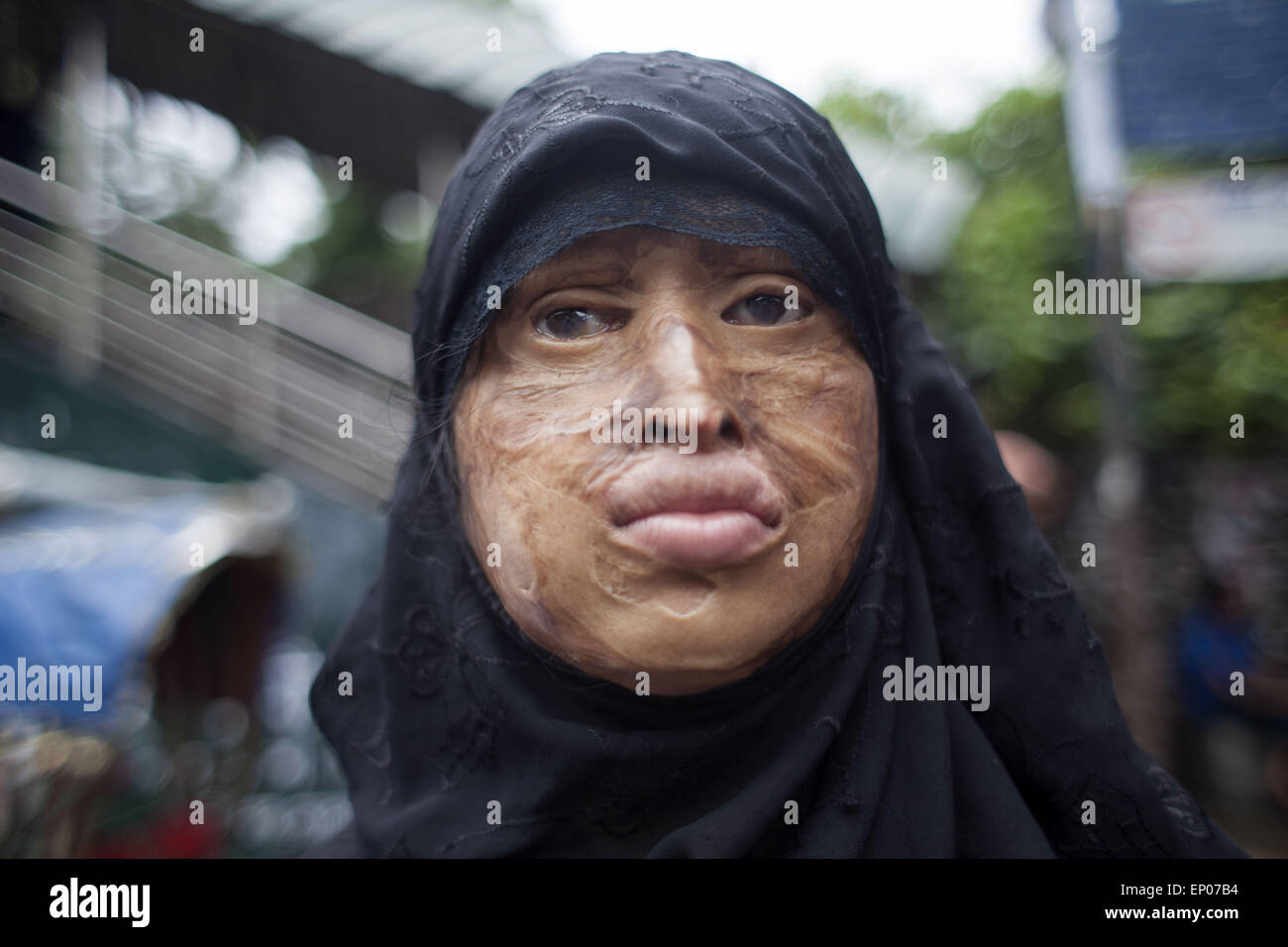 Dhaka, Bangladesh. 12th May, 2015. Survivors of acid attacks, attend a ...
