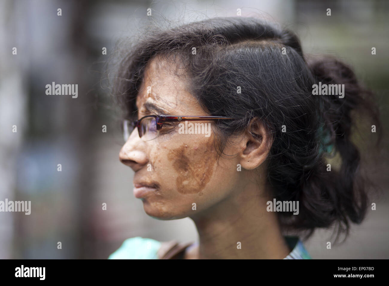 Female Victim Acid Attack Face High Resolution Stock Photography and ...