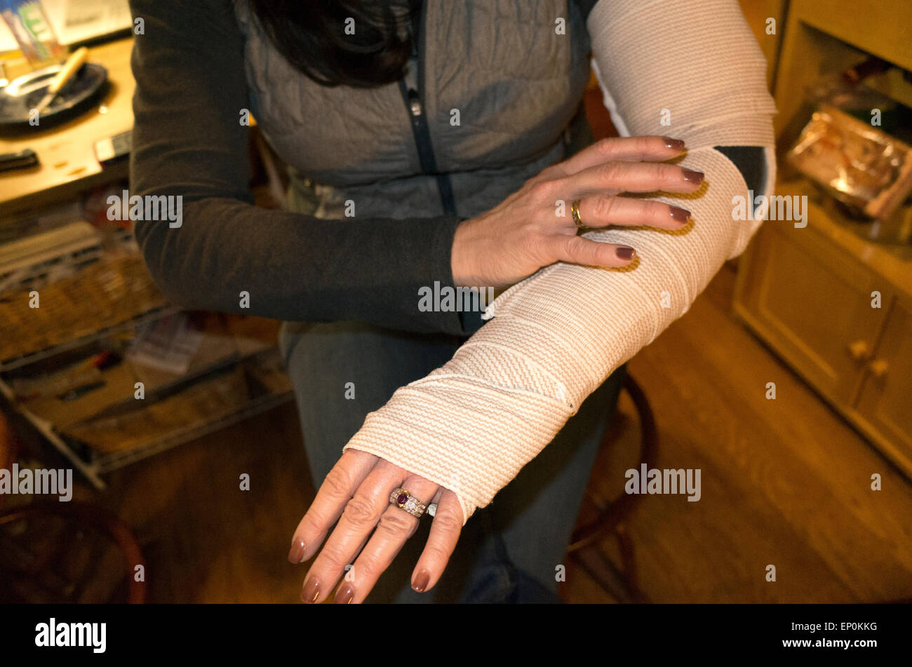 Woman holding wrapped arm treating a broken elbow after having slipped ...