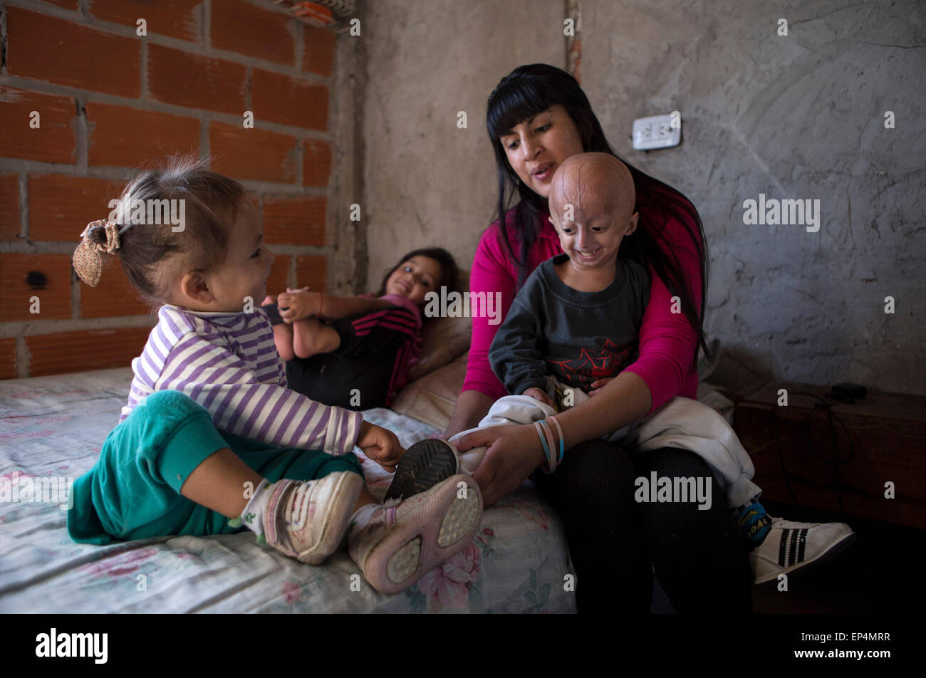 Progeria hi-res stock photography and images - Alamy