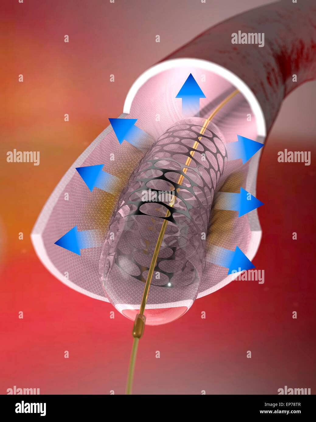 Angioplasties hi-res stock photography and images - Alamy