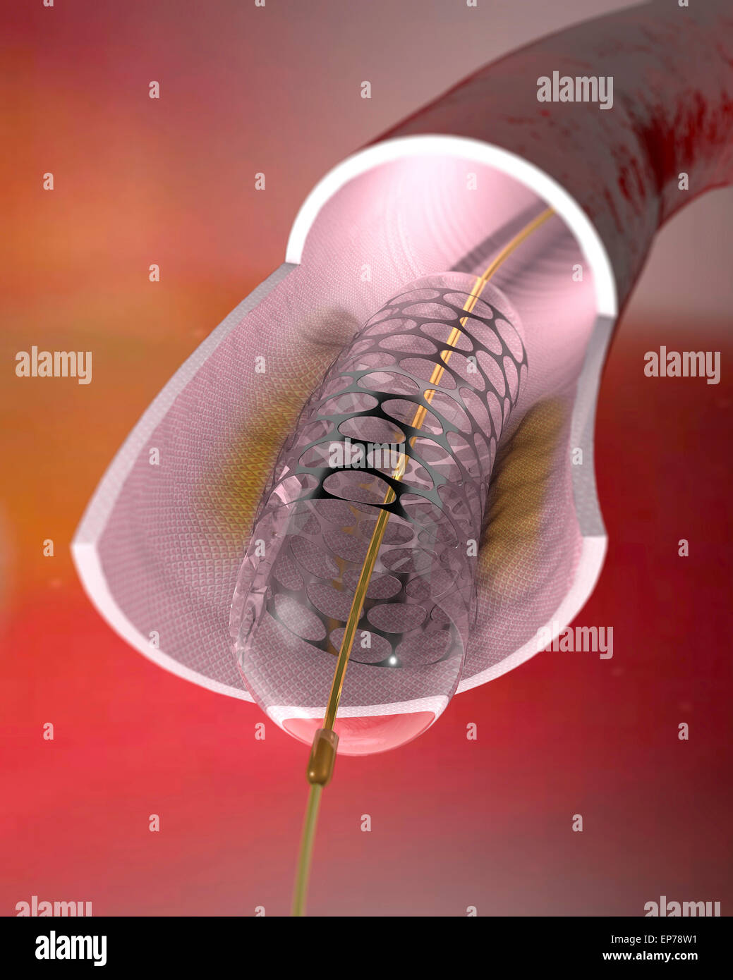 Heart stent hi-res stock photography and images - Alamy