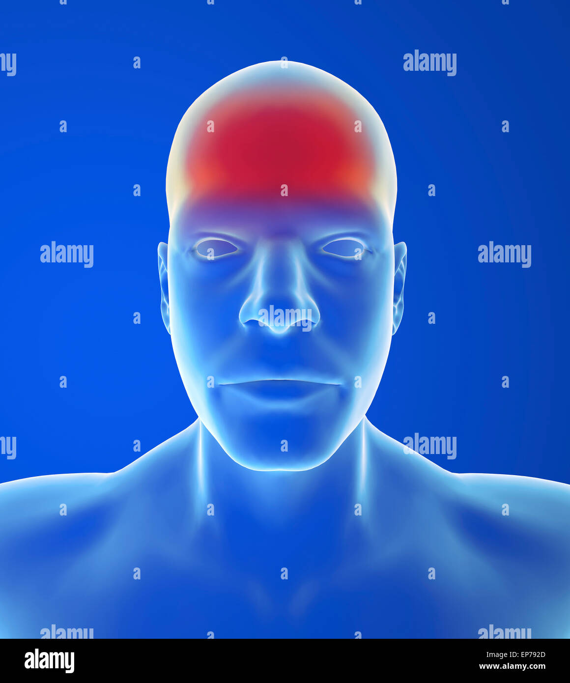 Type headache: Tension pain is like a band squeezing the head on blue ...