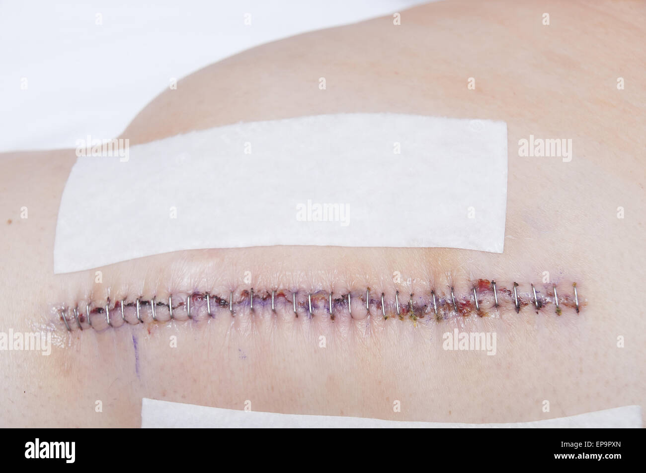 Joint replacement operation hi-res stock photography and images - Alamy