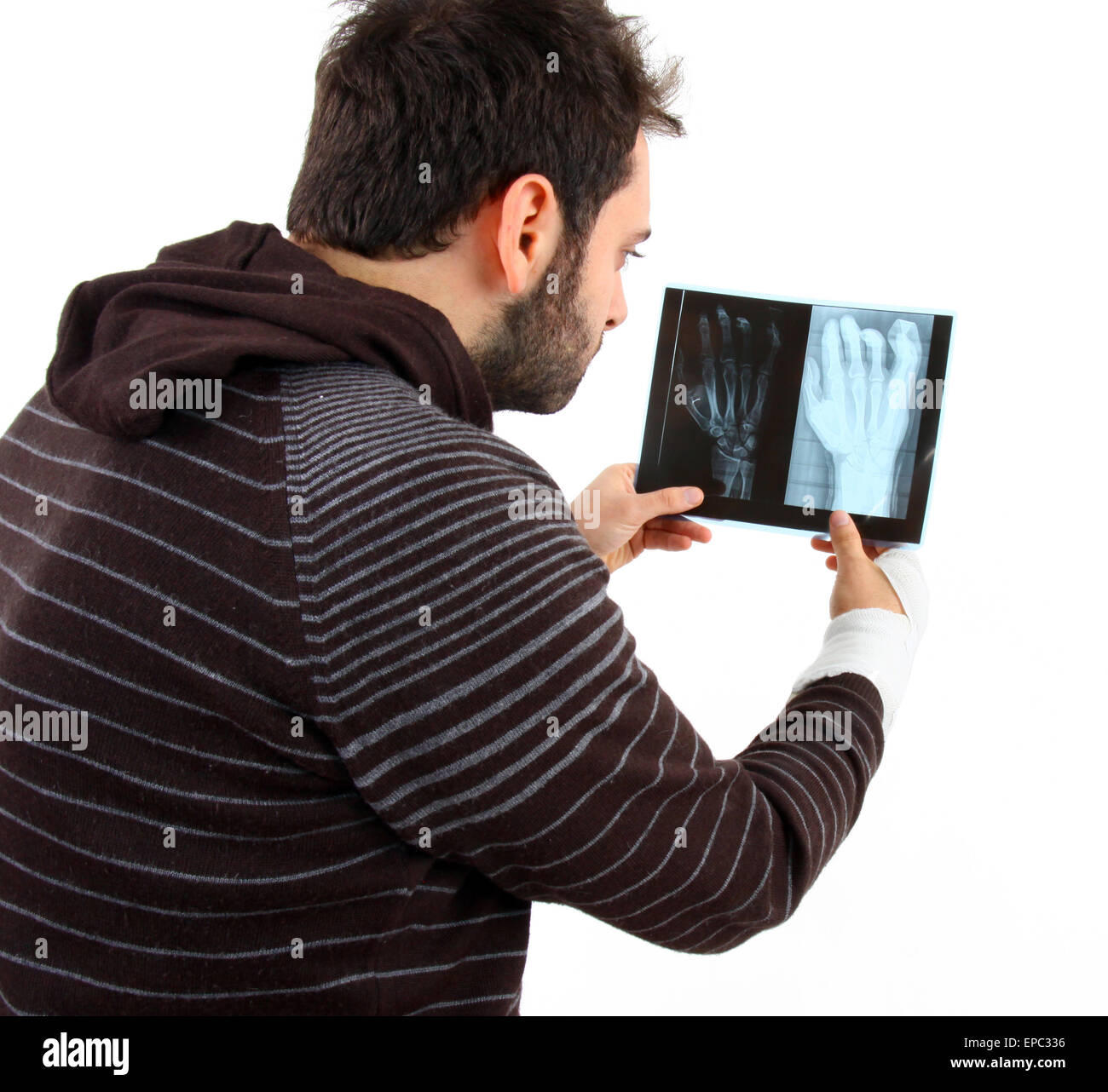 Man with a hand fracture and x-ray film on white background Stock Photo ...