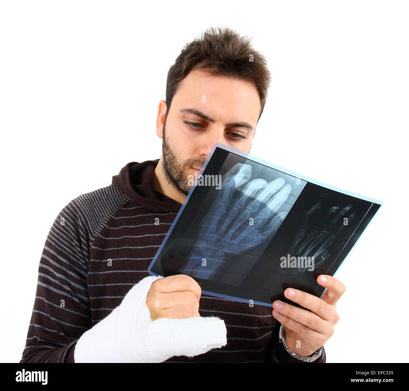 Hand bone fracture hi-res stock photography and images - Alamy