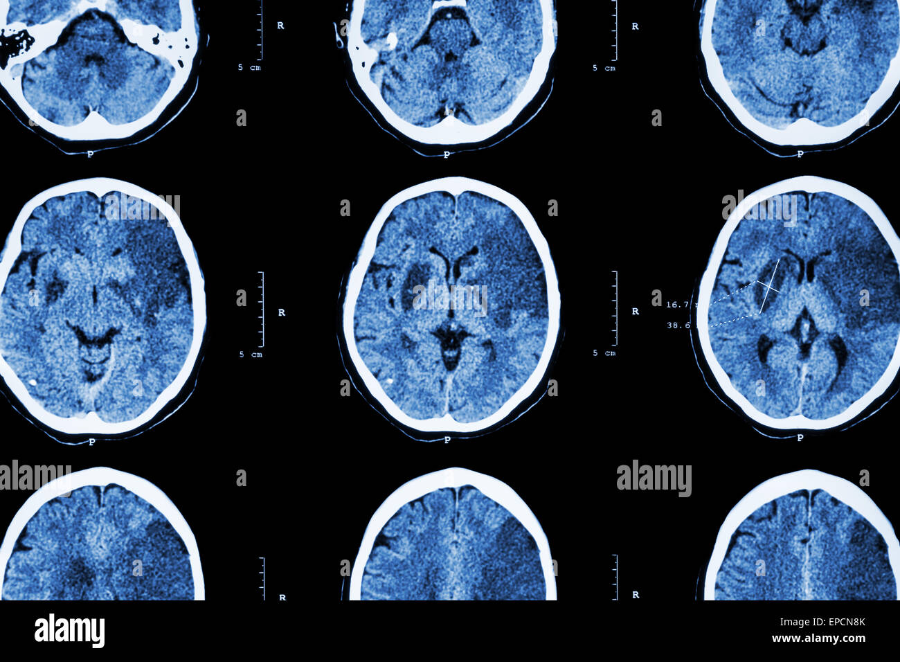 Ischemic stroke : ( CT of brain show cerebral infarction at left ...