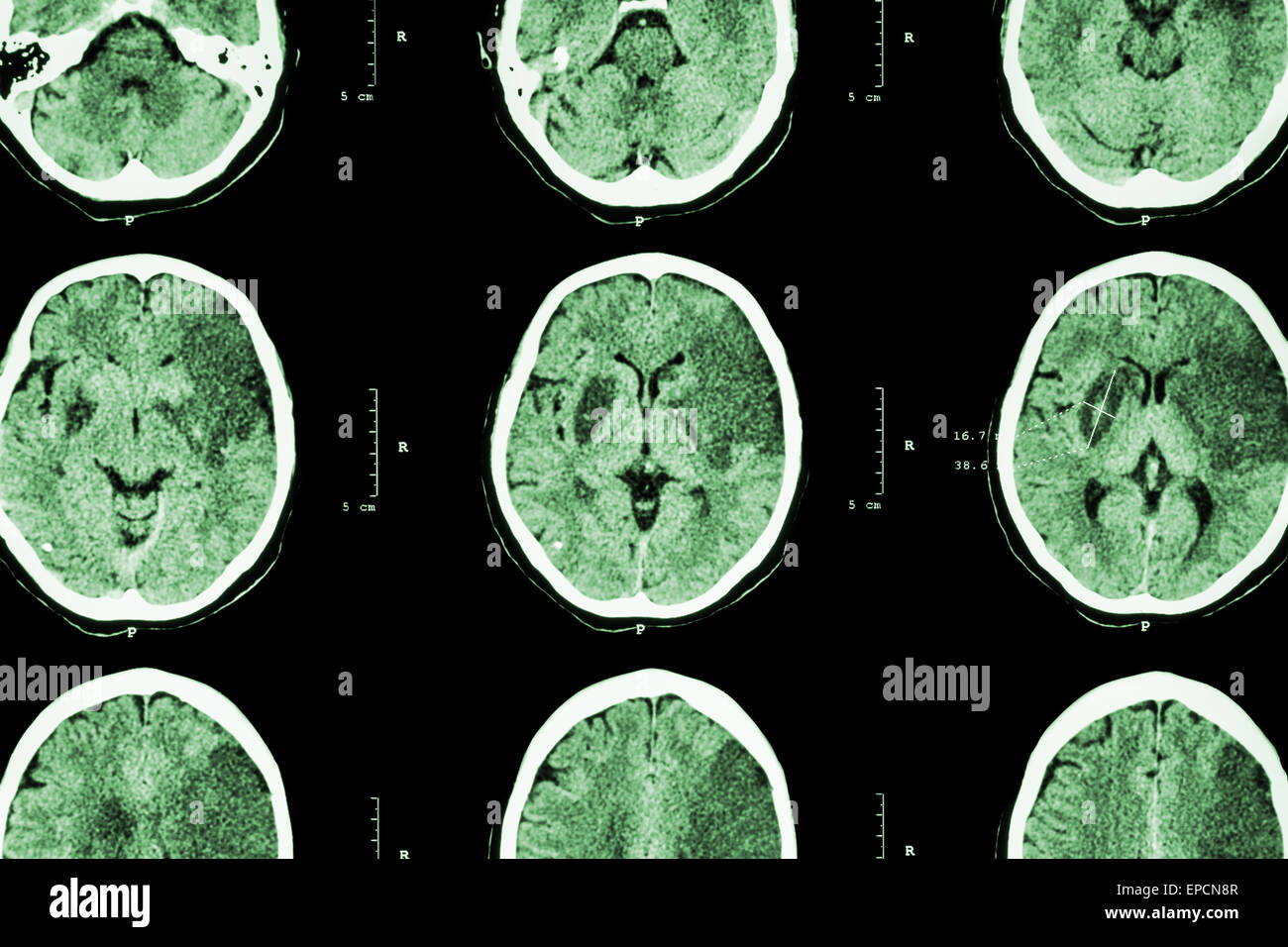 Ischemic stroke : ( CT of brain show cerebral infarction at left ...