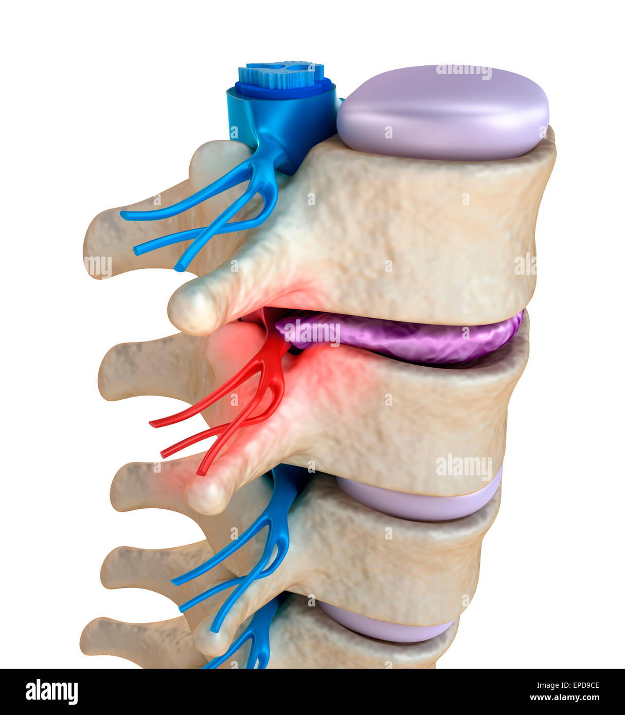 Spinal cord under pressure of bulging disc Stock Photo - Alamy