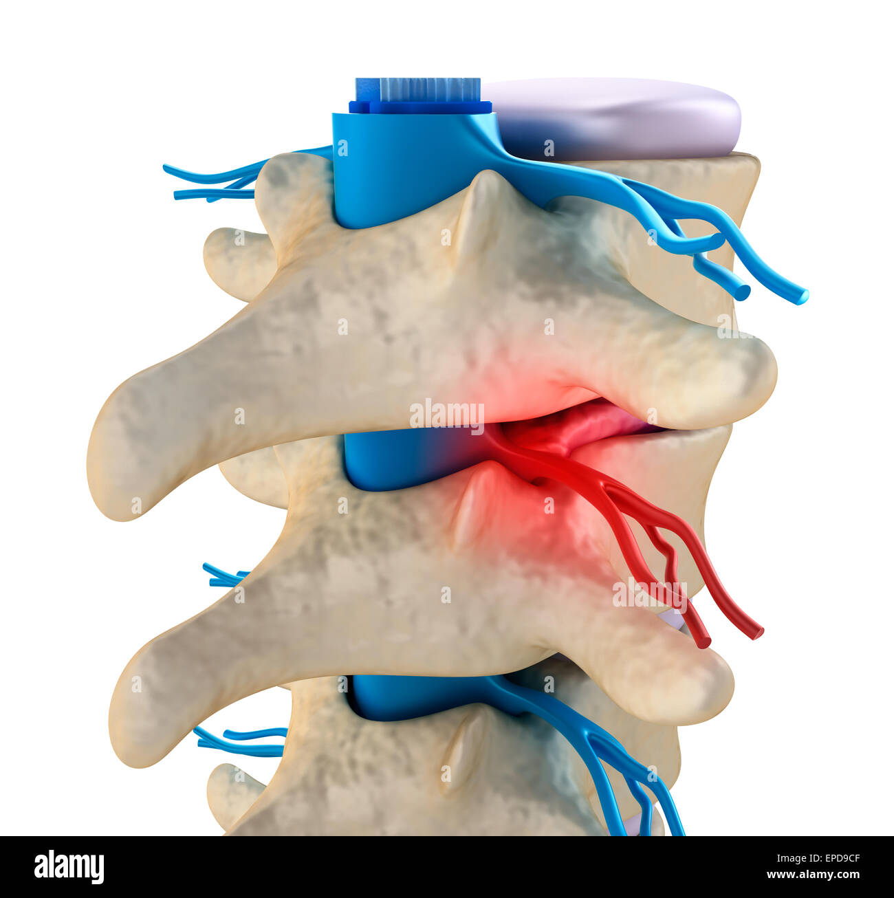 Disc extrusion hi-res stock photography and images - Alamy