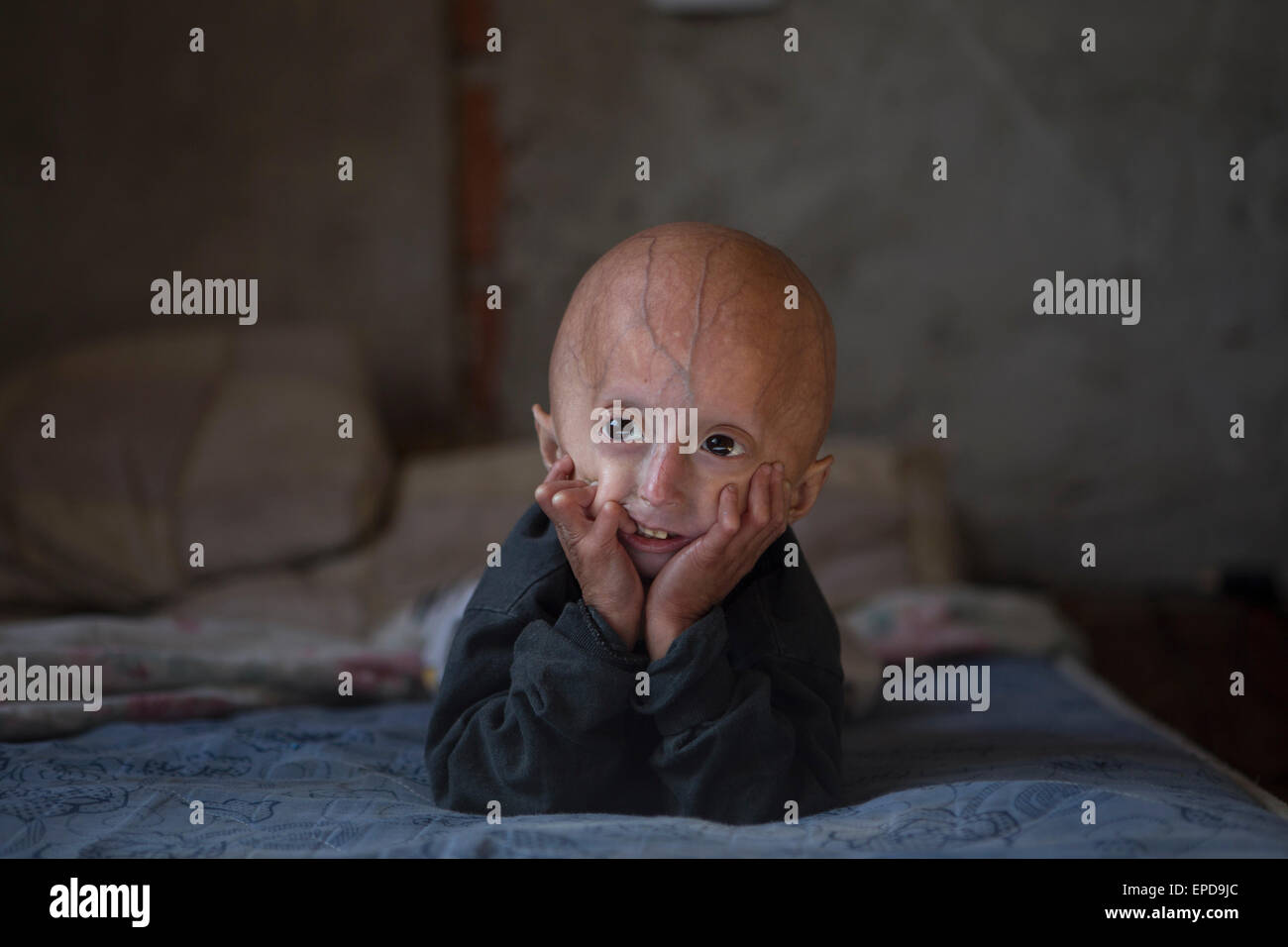 Progeria hi-res stock photography and images - Alamy