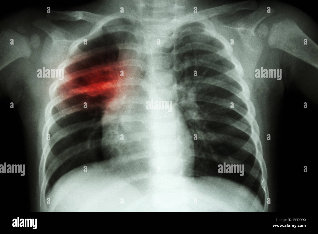 Pulmonary Tuberculosis ( Chest X-ray of child : show patchy ...
