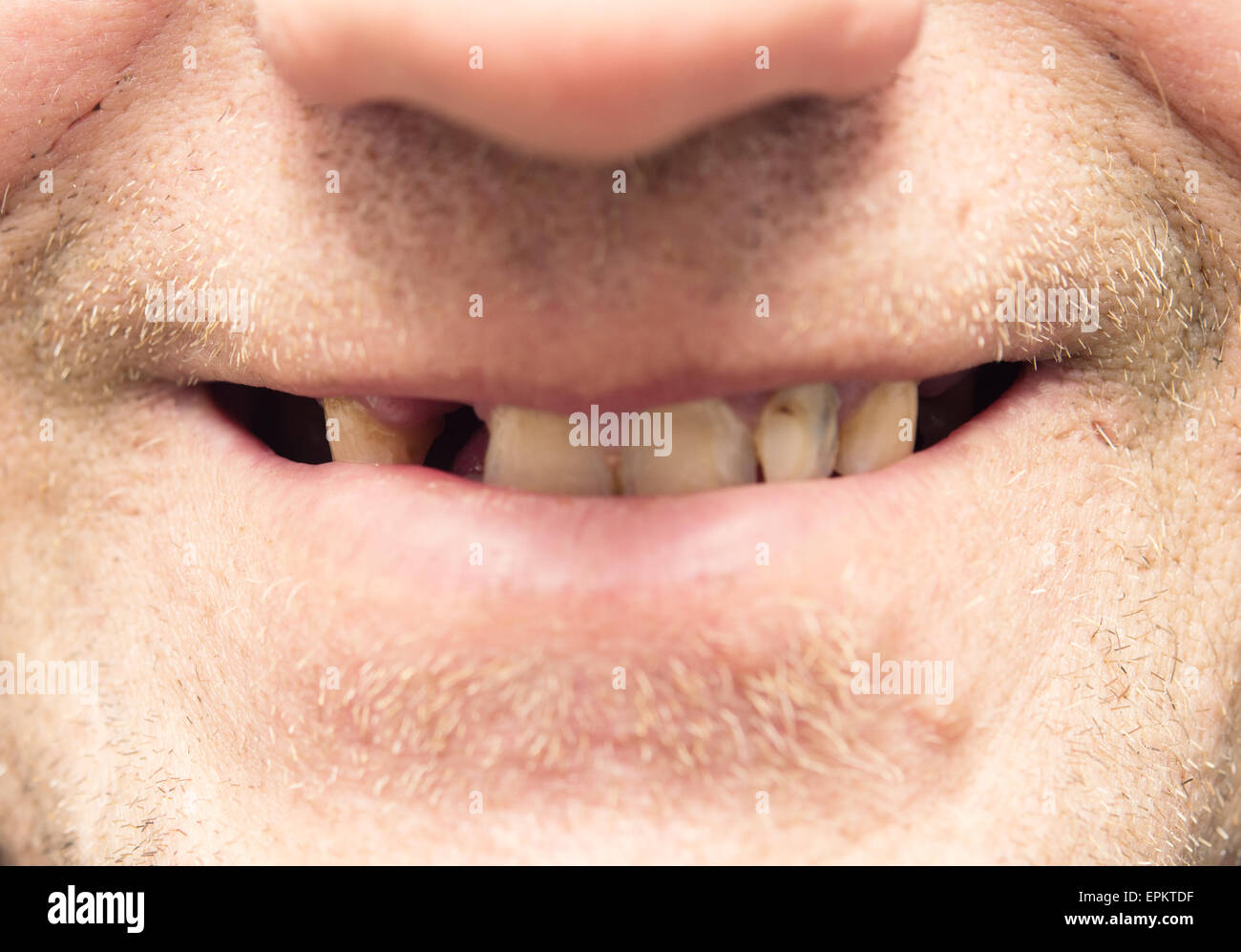 Sick tooth bacteria symbol hi-res stock photography and images - Alamy