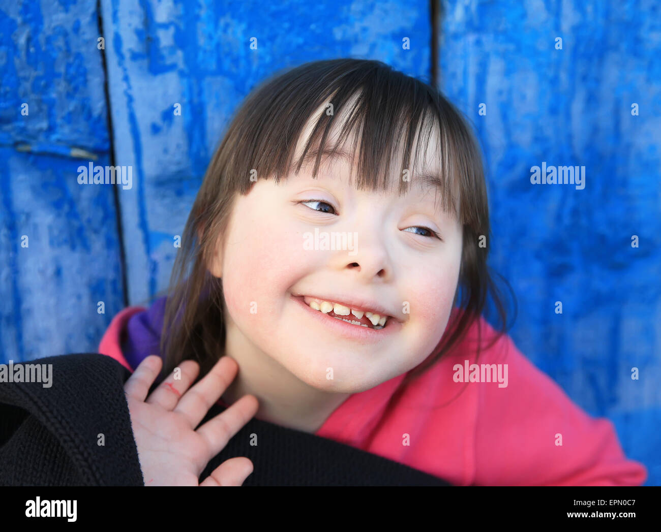 Blue baby syndrome hi-res stock photography and images - Alamy