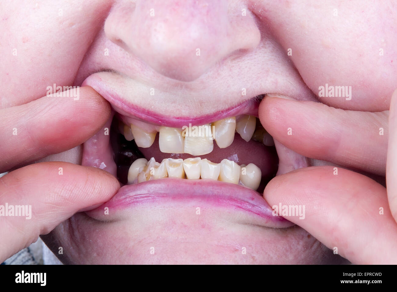Crumbled tooth hi-res stock photography and images - Alamy