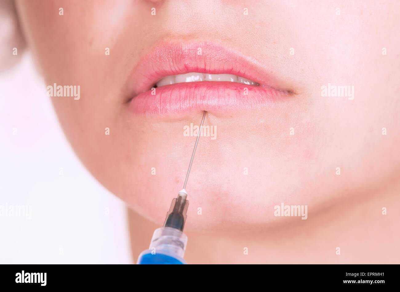 Botox treatment before after hi-res stock photography and images - Alamy