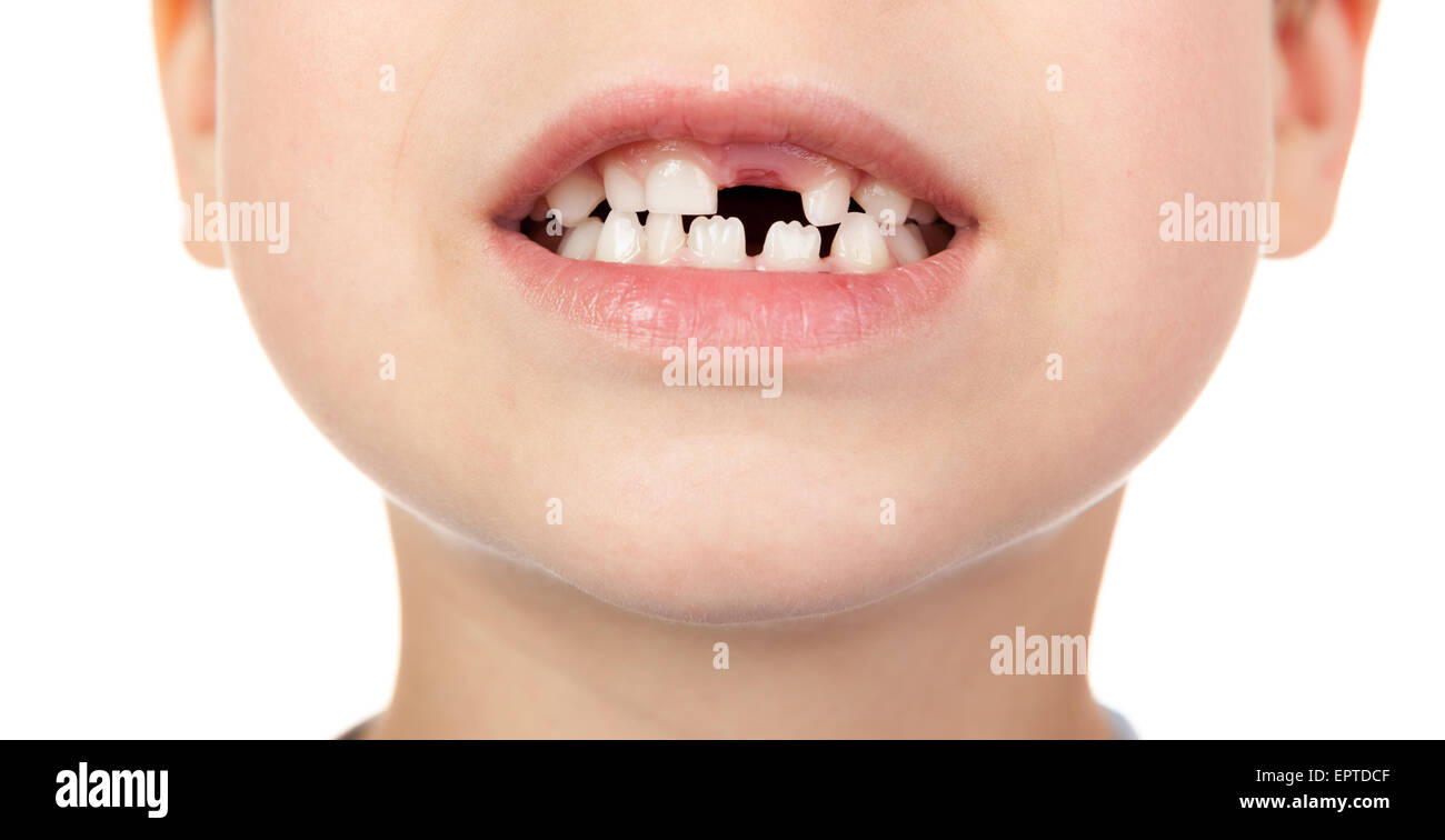 lost tooth boy portrait closeup Stock Photo - Alamy