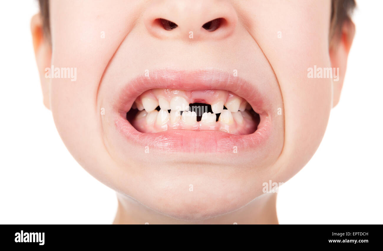 Boy portrait with a lost tooth Stock Photo - Alamy