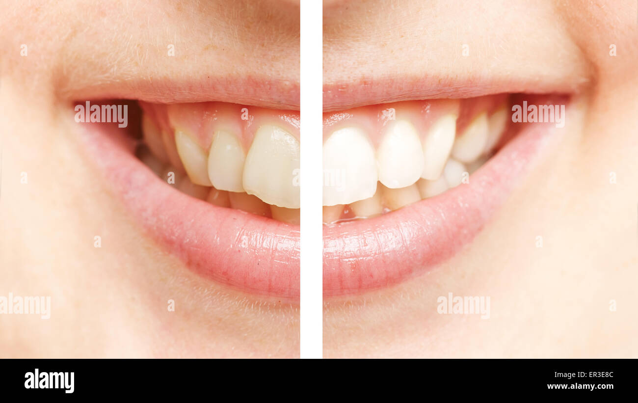 Comparison between white teeth after bleaching and before teeth ...