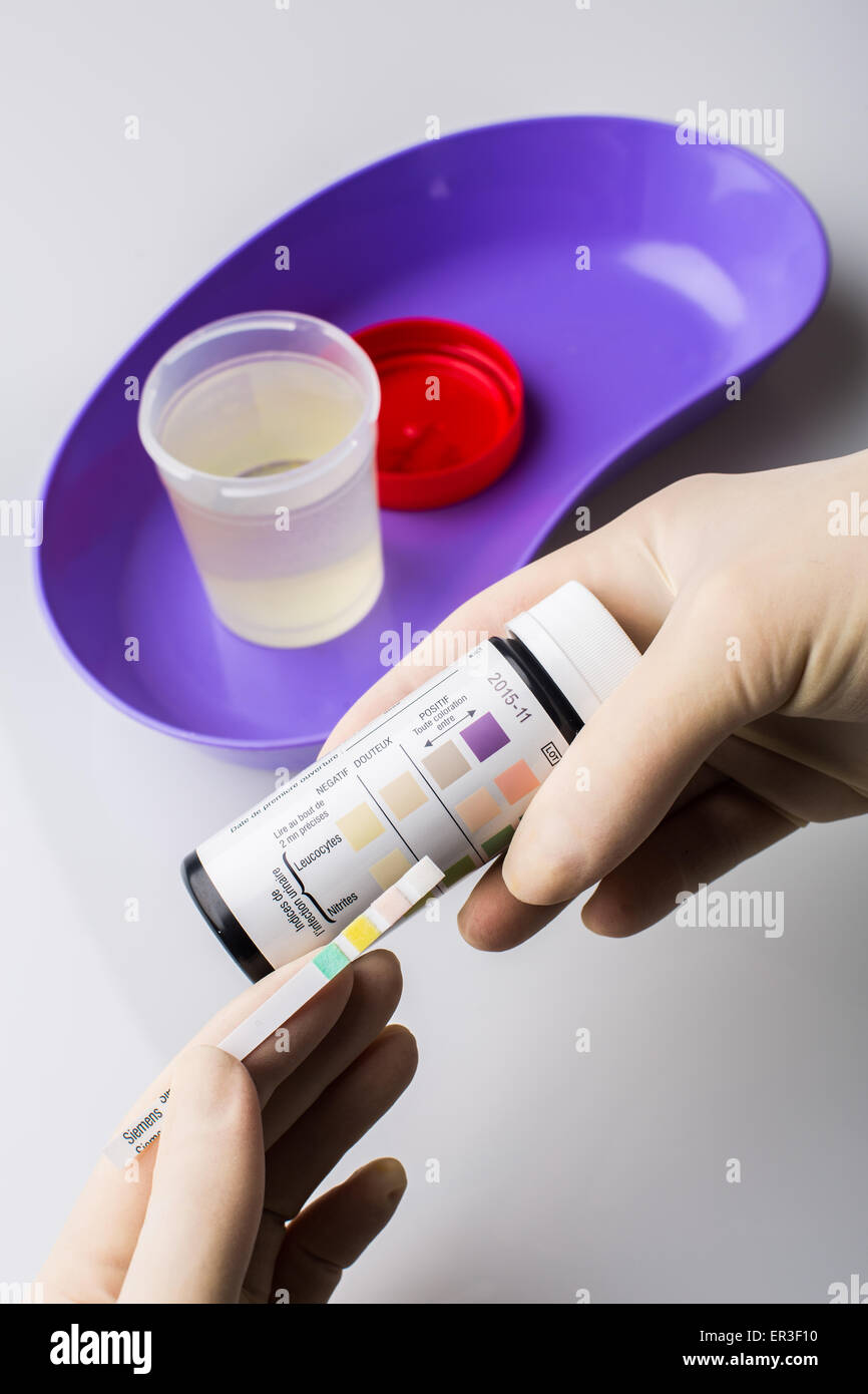 Urine sample with a test strip showing the results. This urine analysis ...