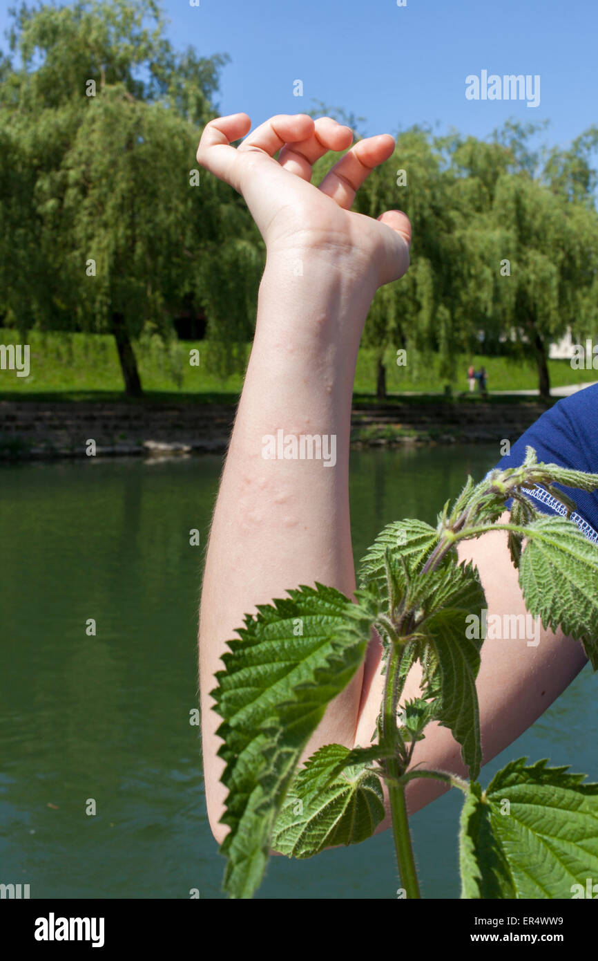 Nettle rash hi-res stock photography and images - Alamy