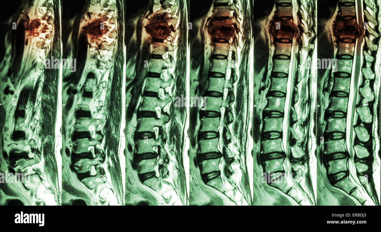 MRI of Lumbar & Thoracic spine : show fracture of thoracic spine and ...