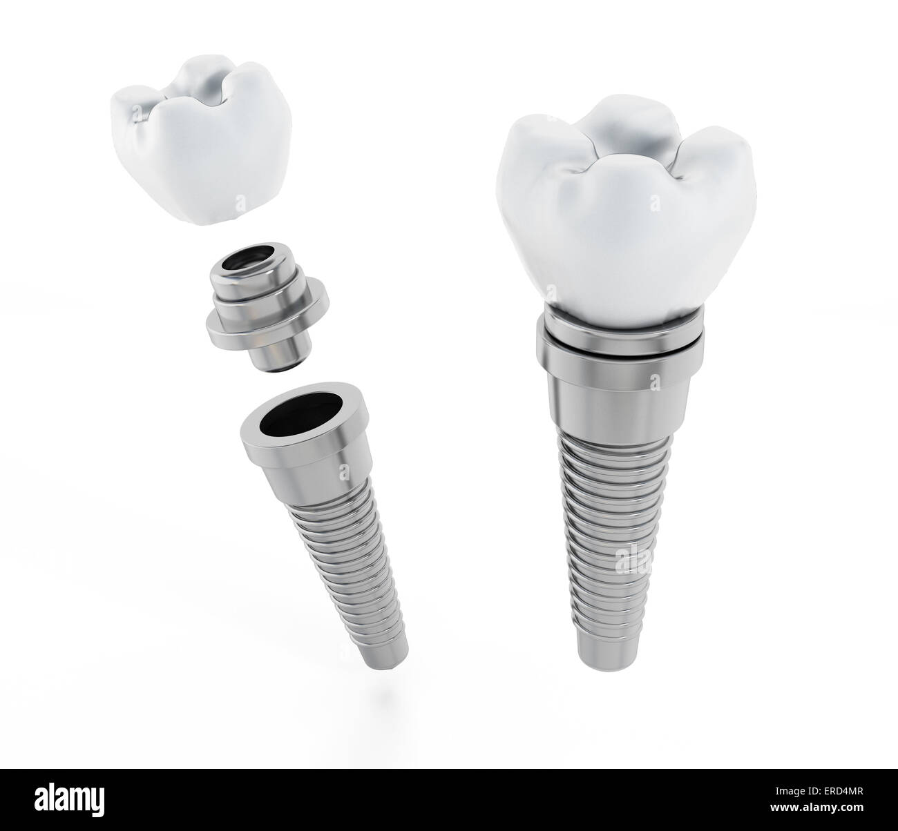 Dental implant models isolated on white Stock Photo - Alamy