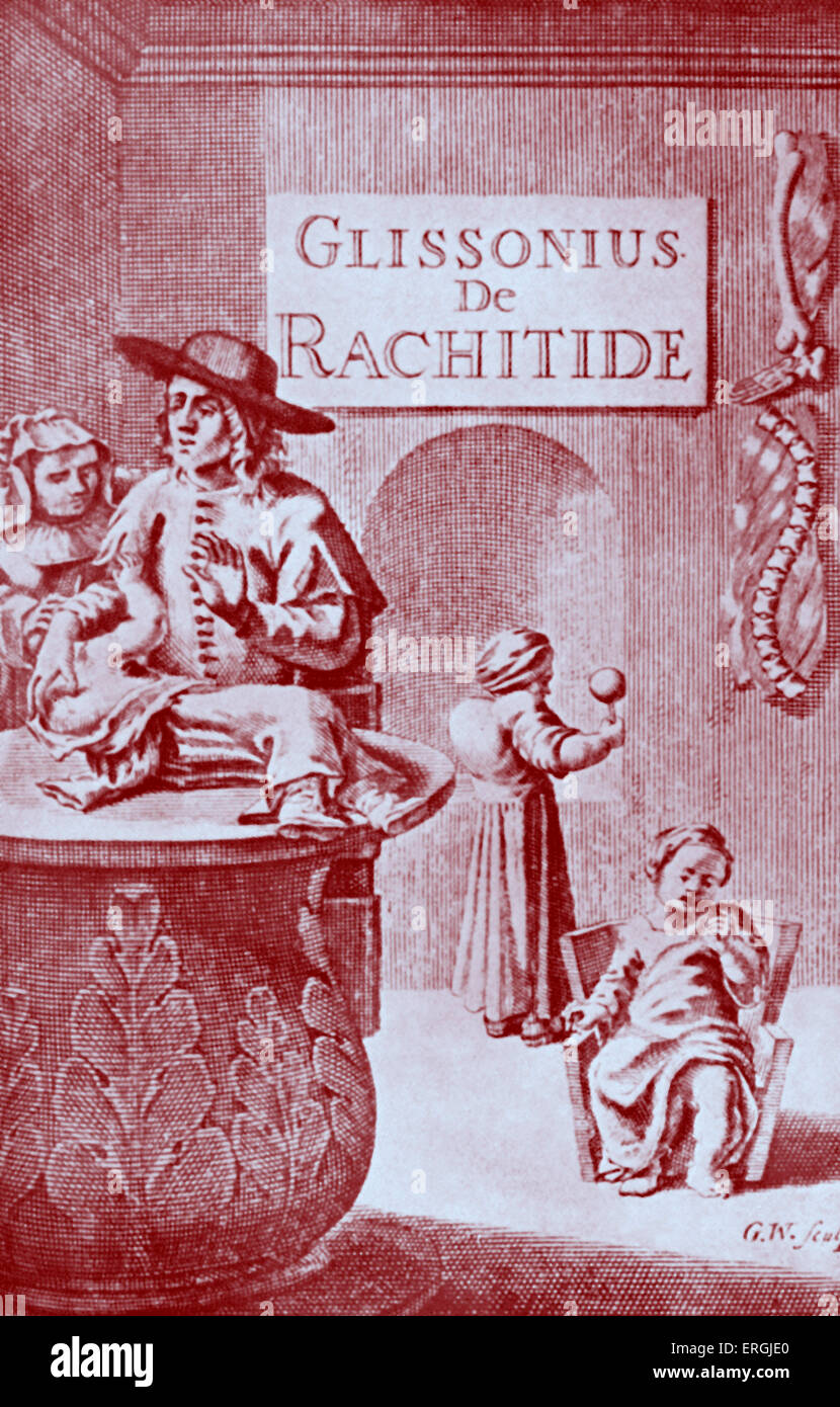 Rickets child hi-res stock photography and images - Alamy