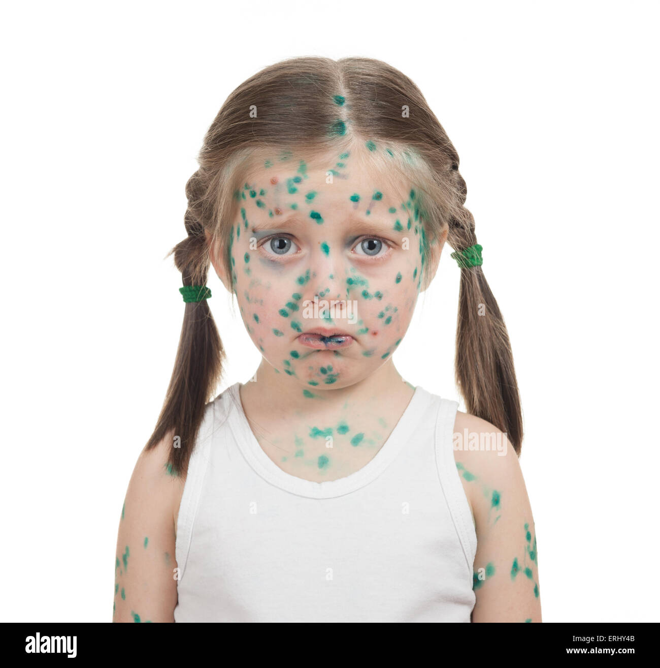 sick child. chickenpox. isolated Stock Photo - Alamy