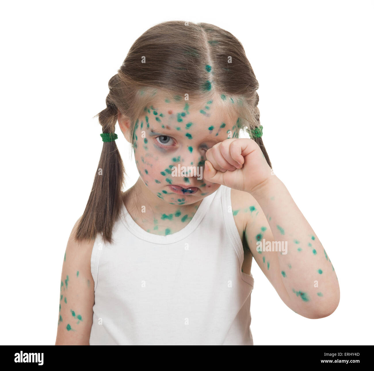 sick child. chickenpox. isolated Stock Photo - Alamy
