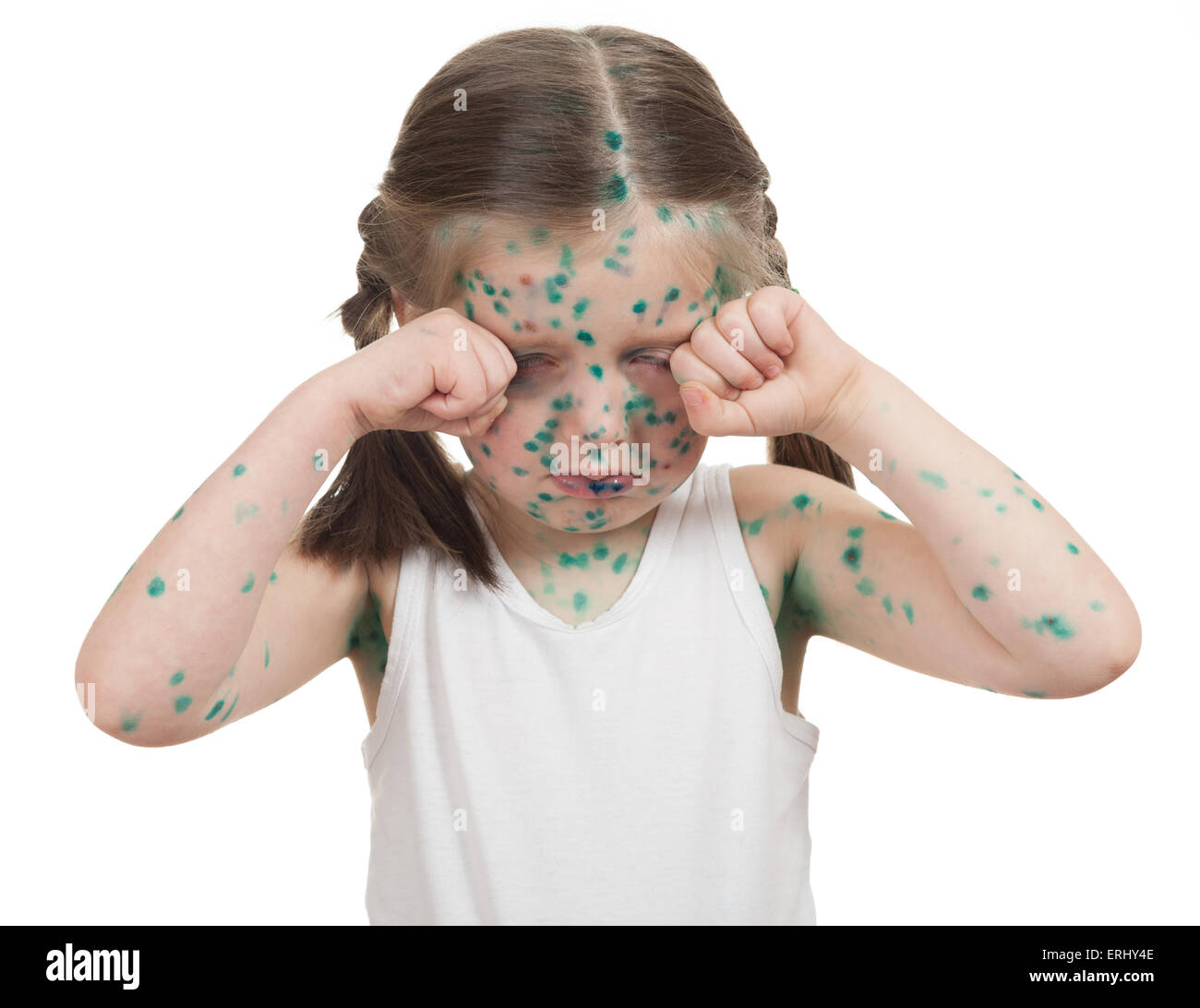 sick child. chickenpox. isolated Stock Photo - Alamy
