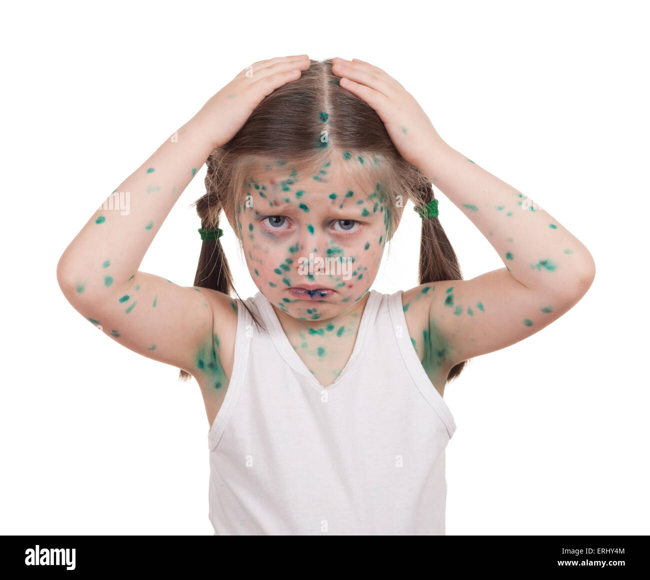sick child. chickenpox. isolated Stock Photo - Alamy