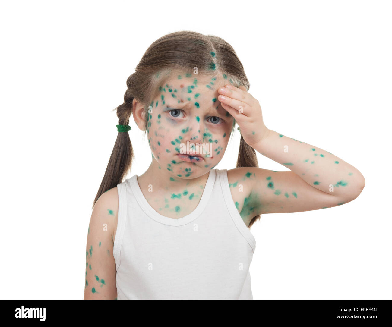 sick child. chickenpox. isolated Stock Photo - Alamy
