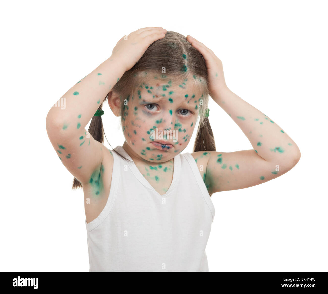 sick child. chickenpox. isolated Stock Photo - Alamy