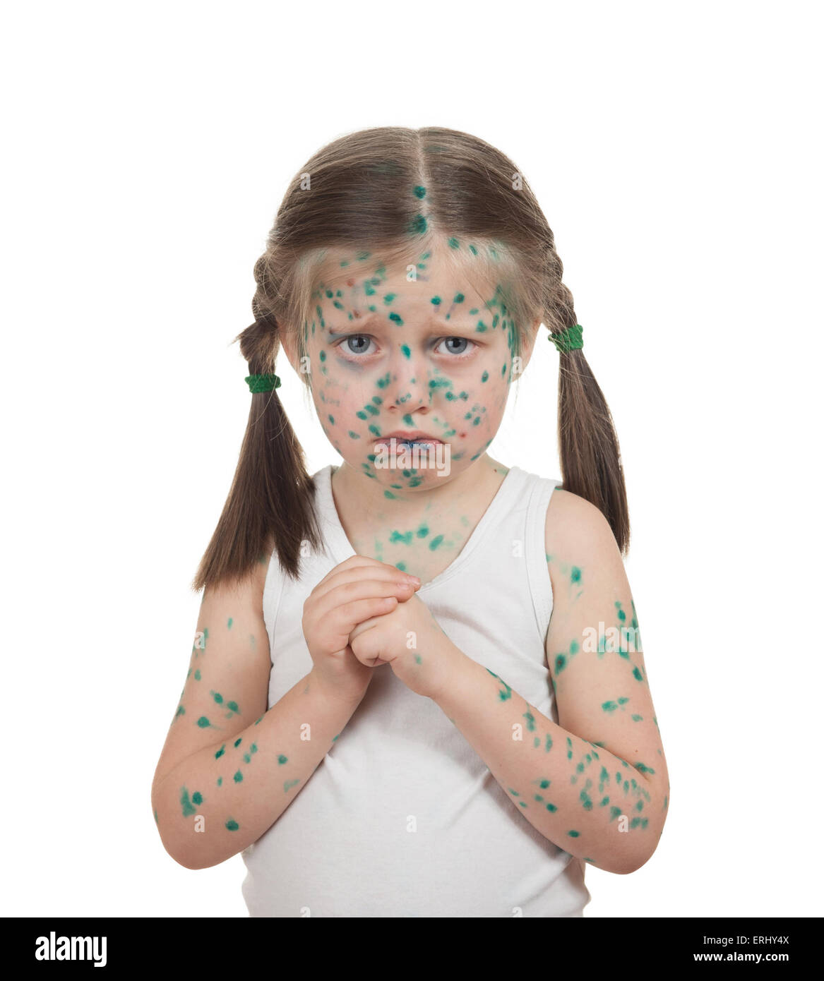 sick child. chickenpox. isolated Stock Photo - Alamy